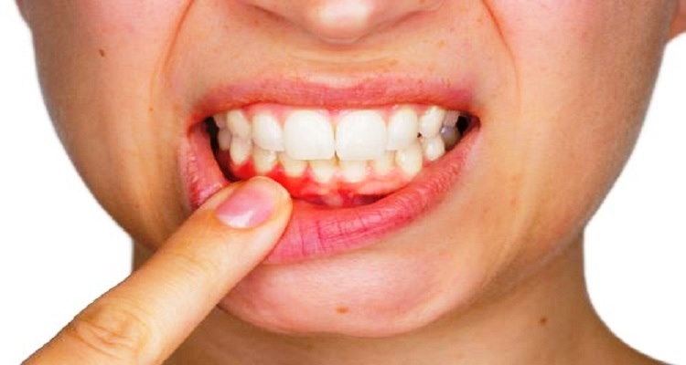 Symptoms, Causes, And Prevention Of Tooth Abscesses – Health Facilities